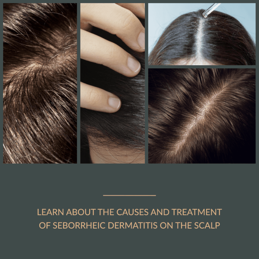 Can Seborrheic Dermatitis Be Cured Permanently? Exploring Treatment ...